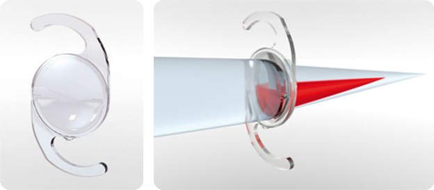 Cataract | London Eye Surgery | Simon Levy | London | United Kingdom